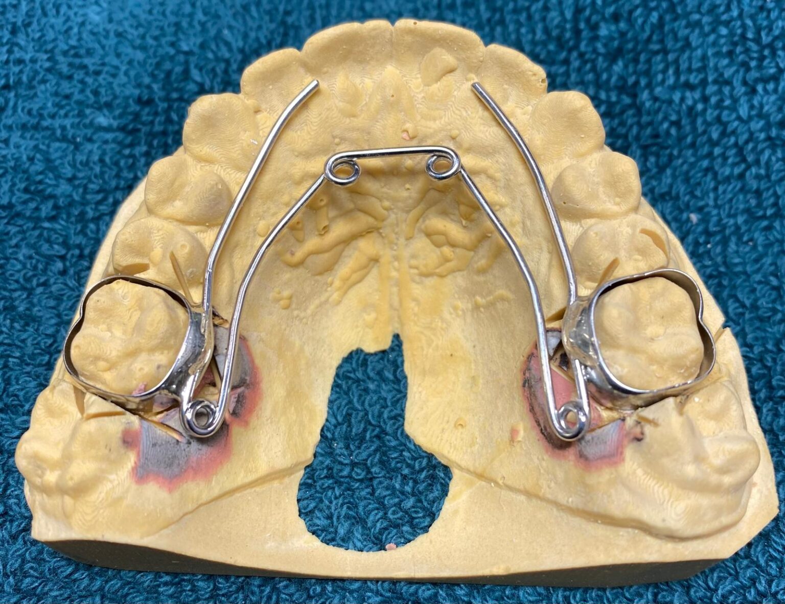 Fixed appliances – Digital Orthodontic Dental Lab located in Melbourne